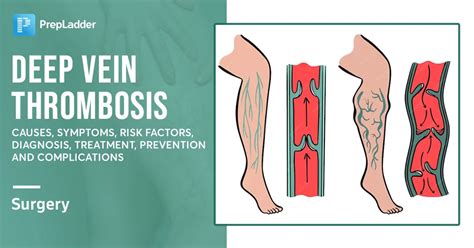 Deep Vein Thrombosis Dvt Symptoms Causes And 57 Off
