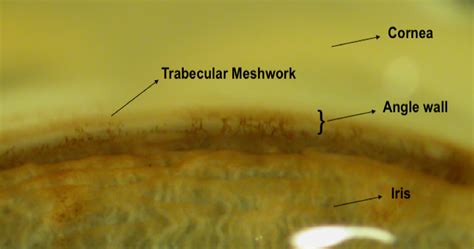 Gonioscopy Structures Gonioscopy Normal Angle 2