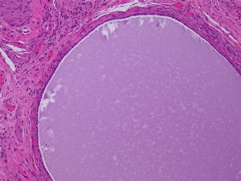 Pathology Outlines Epithelial Inclusion Cyst