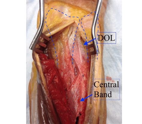 It Shows The Anatomy Of The Interosseous Ligament And The Distal