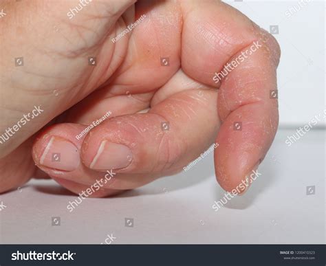 Psoriasis Fingertips