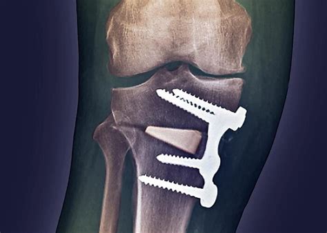 Knee Realignment Surgery X Ray Greeting Card By Zephyr