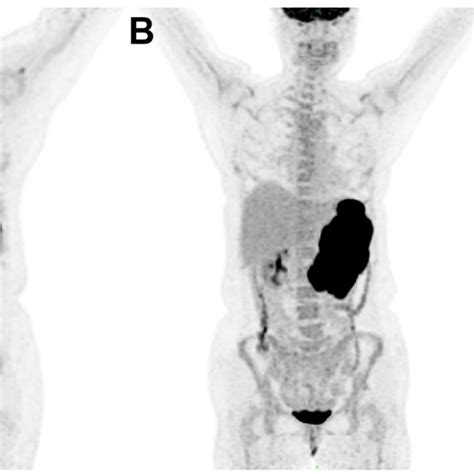 MIP Images Of Focal A Diffuse B And Normal C FDG Uptake Patterns Download Scientific