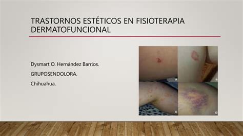 Psoriasis Neuro Dermatitispptx