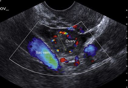 Doppler Ultrasound Of The Female Pelvis Radiology Key