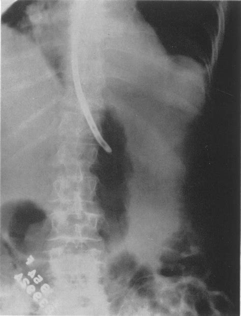 Ruptured Spleen X Ray
