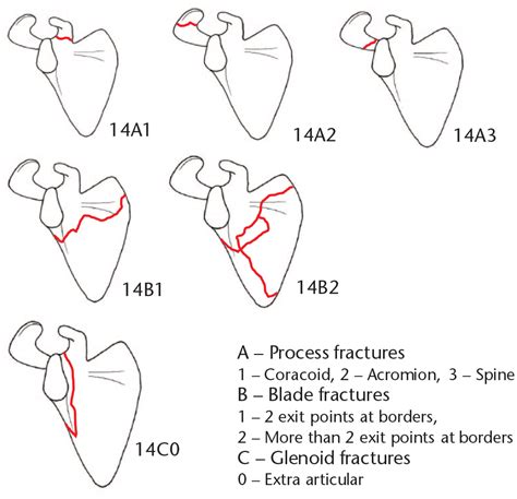 Scapula Fracture Ideberg Classification At Jorge Courter Blog