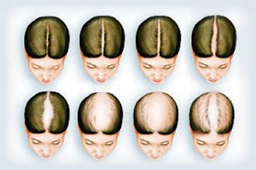 Female Pattern Baldness Women Pattern Hair Loss Treatment Clinic