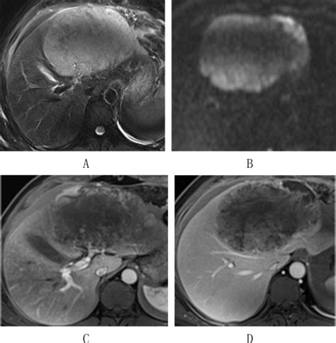 Poorly Differentiated Large Hcc With A Mosaic Pattern Of Enhancement In Download Scientific