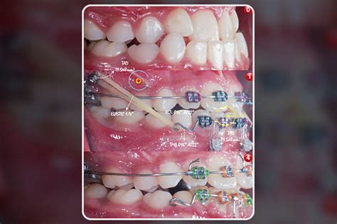 Uso Precoce De Mini Implantes Extra Alveolares No Tratamento Da Classe