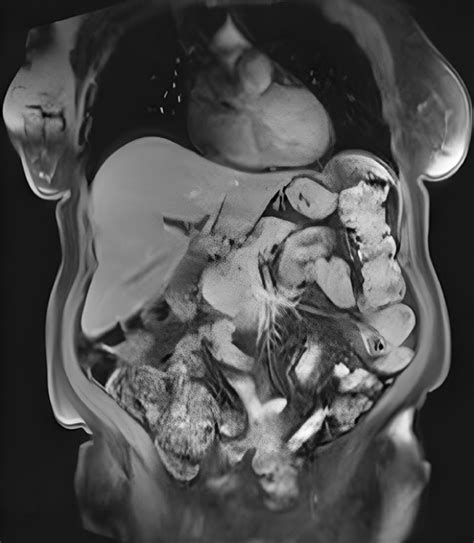Common Bile Duct Polyp An Infrequent Cause Of Jaundice And Biliary