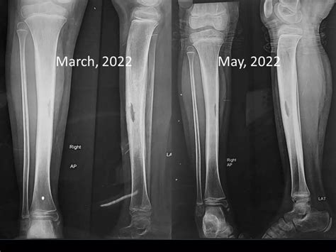 Chronic Recurrent Multifocal Osteomyelitis A Care Report Pptx