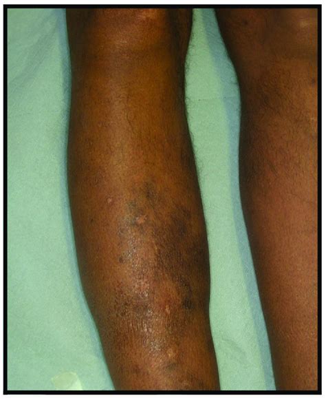 Multiple Brownish Livid Superficial Plaques On The Right Shin