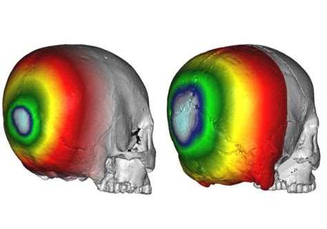 Did The Hirota People Of Japan Intentionally Deform Their Skulls