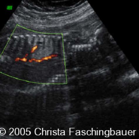 📃 Lung Sequestration Extralobar Infradiaphragmatic