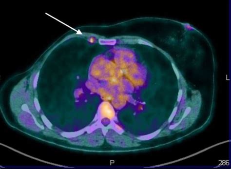 Internal Mammary Node Irradiation Debate Case Closed Not Yet And Maybe Never By Abram Recht