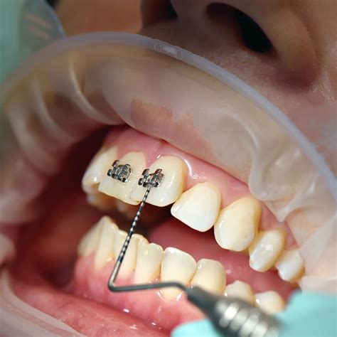 How Do Metal Braces Work Moray Orthodontics