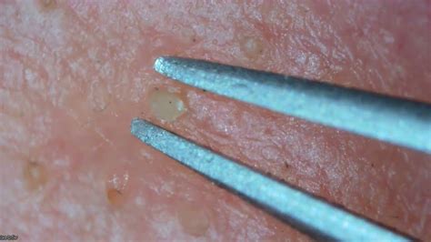 Keratin Plug In Ear At Rose Thyer Blog