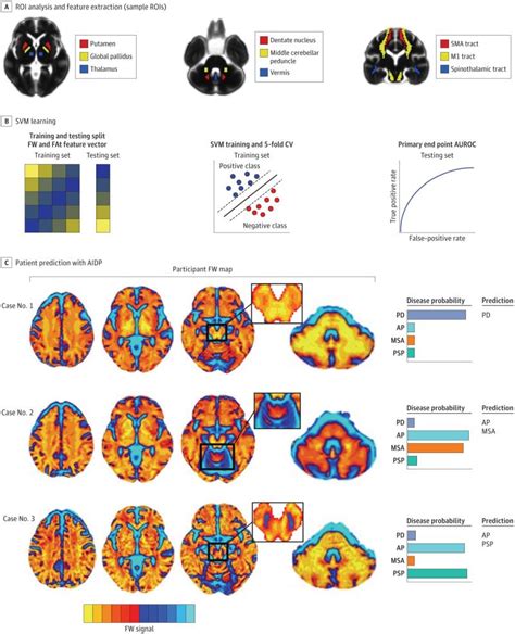 Ai Driven Mri Analysis Improves Accuracy In Distinguishing Parkinsonian