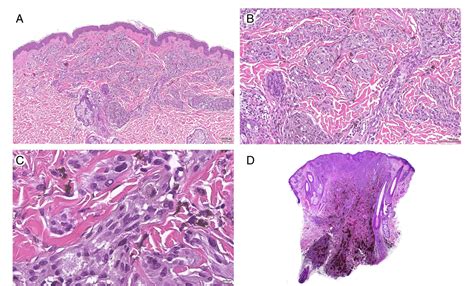 Spindle Cell Nevus Dermnet At Alex Cruz Blog