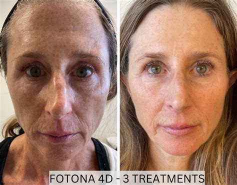 Before And After Skin Suite Marin