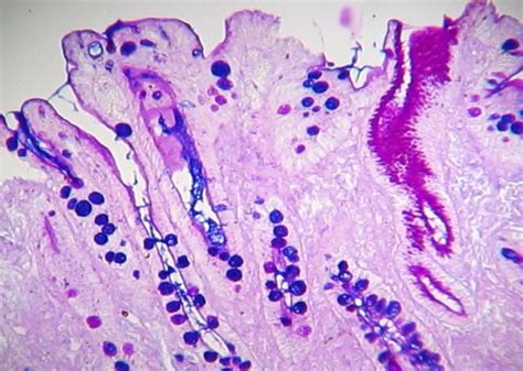Endoscopy Abnormal Cells