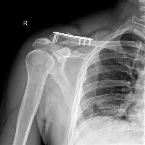 33 Years Mans Follow Up Shoulder Ap X Ray Image Showing That Achieved