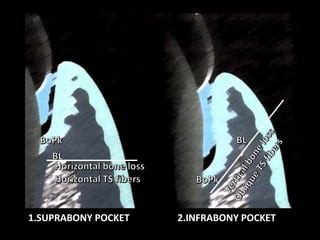 Periodontal Pocket Pptx