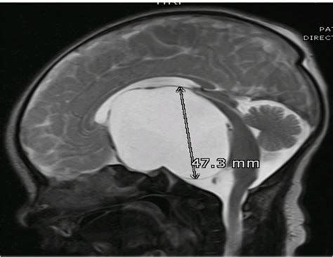 Management Of Arachnoid Cysts A Comprehensive Review Pmc