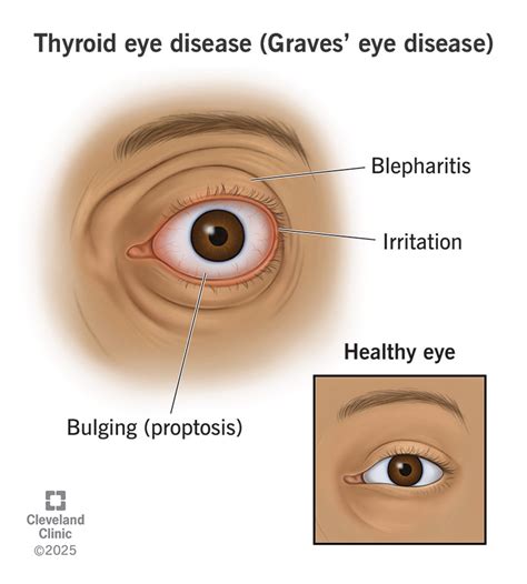 Graves Disease Symptoms Eyes Pictures Causes Treatment