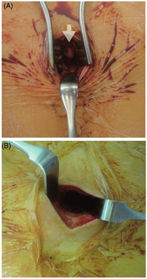 Protruding Xiphoid Process