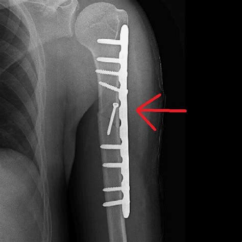 Anterior Posterior Radiograph Showing Orif With Plate Osteosynthesis