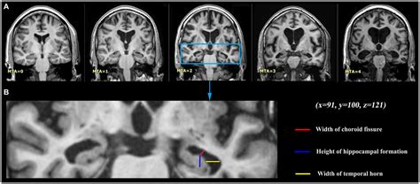 Frontiers Executive Function Deficits And Medial Temporal Lobe