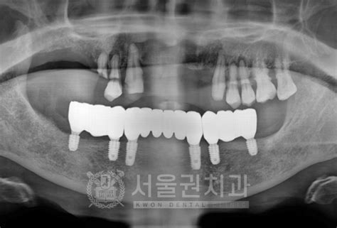 즉시 로딩 임플란트 서울권치과
