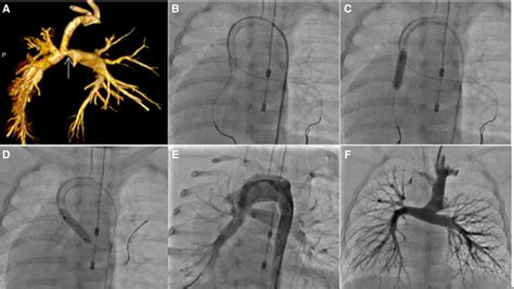 Patent Ductus Arteriosus Stenting For All Ductal Dependent Cyanotic