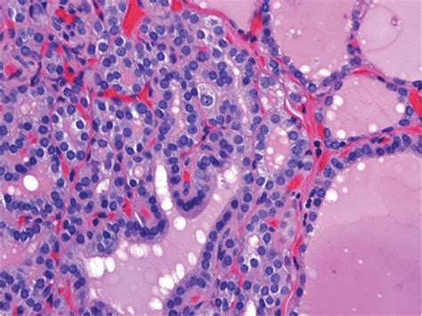 Surgical Pathology Of Thyroid Gland Demonstrating Follicular