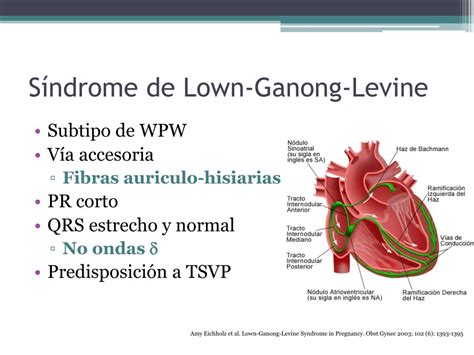 Ppt Extrasistolia Ventricular Síndromes De Preexitacion Wolff