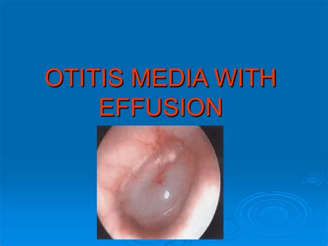 Tympanic Membrane Acute Otitis Media At Wendell Blakely Blog