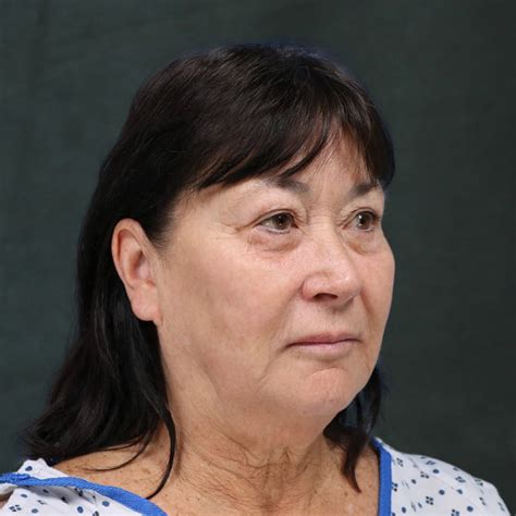 Before And After Deep Plane Facelift Procedures Dr William Harris