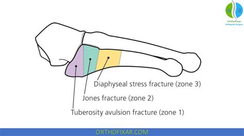 5th Metatarsal Fracture Orthopedic Learning