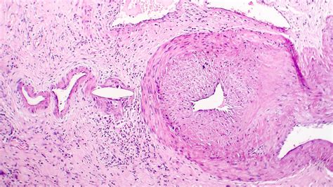 Cholecystitis Causes Triggers And Risk Factors