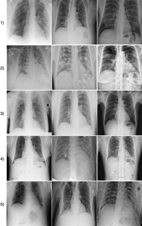 COVID Net A Tailored Deep Convolutional Neural Network Design For Detection Of COVID Cases