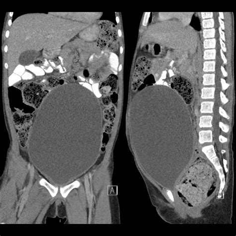 Pediatric Constipation Pediatric Radiology Reference Article