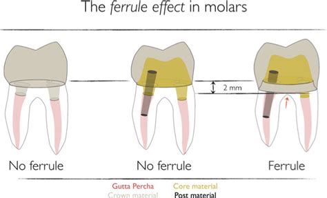 The Ferrule Effect In Molars The Guidebook To Molar Endodontics