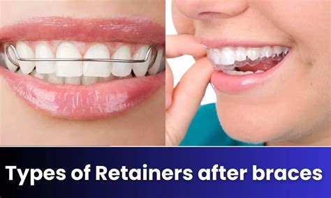 Types Of Retainers After Braces