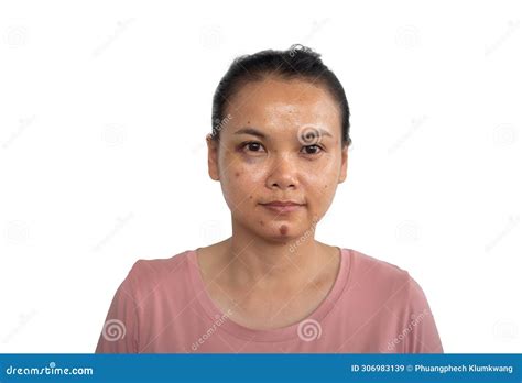 Woman Face Bruised Due To Surgery Stock Image Image Of Cosmetologist