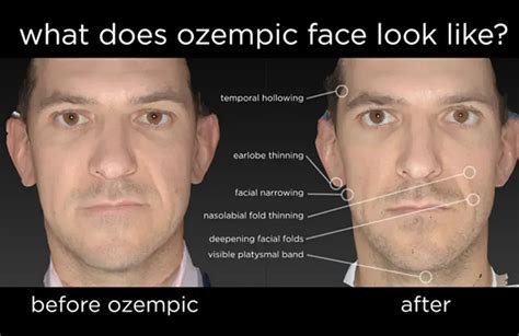 Understanding Ozempic Face And How To Restore Youthful Skin With Botox Fillers And Skin