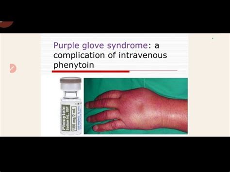 Iv Phenytoin Eptoin Causes Purple 💜 Glove Syndrome Youtube