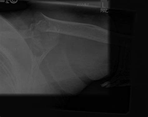 Bonefracture Bonefracture Siyyi Roboflow Universe