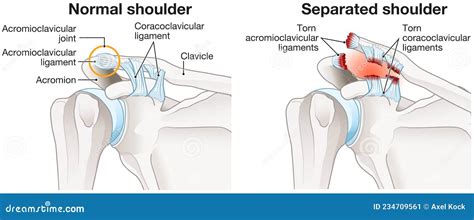 Acromioclavicular Joint Separation Or Ac Joint Separation Or Shoulder